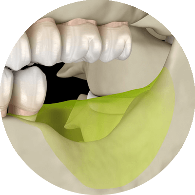 Bone Grafting | St Pete Implant Center | Treat Bone Loss