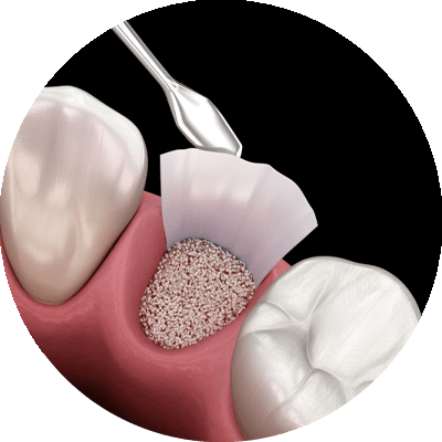Bone Grafting | St Pete Implant Center | Treat Bone Loss