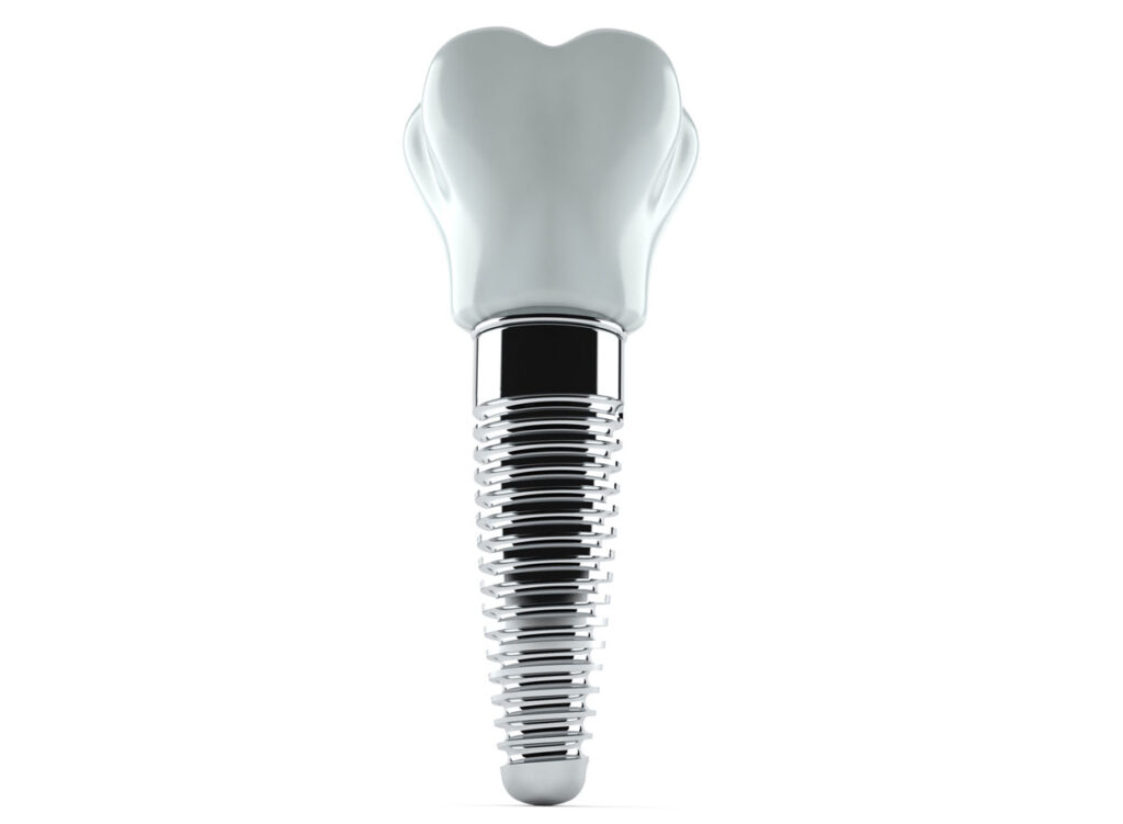 Dental Implants | Full Mouth Dental Implants | Sedation - Ellenton, FL